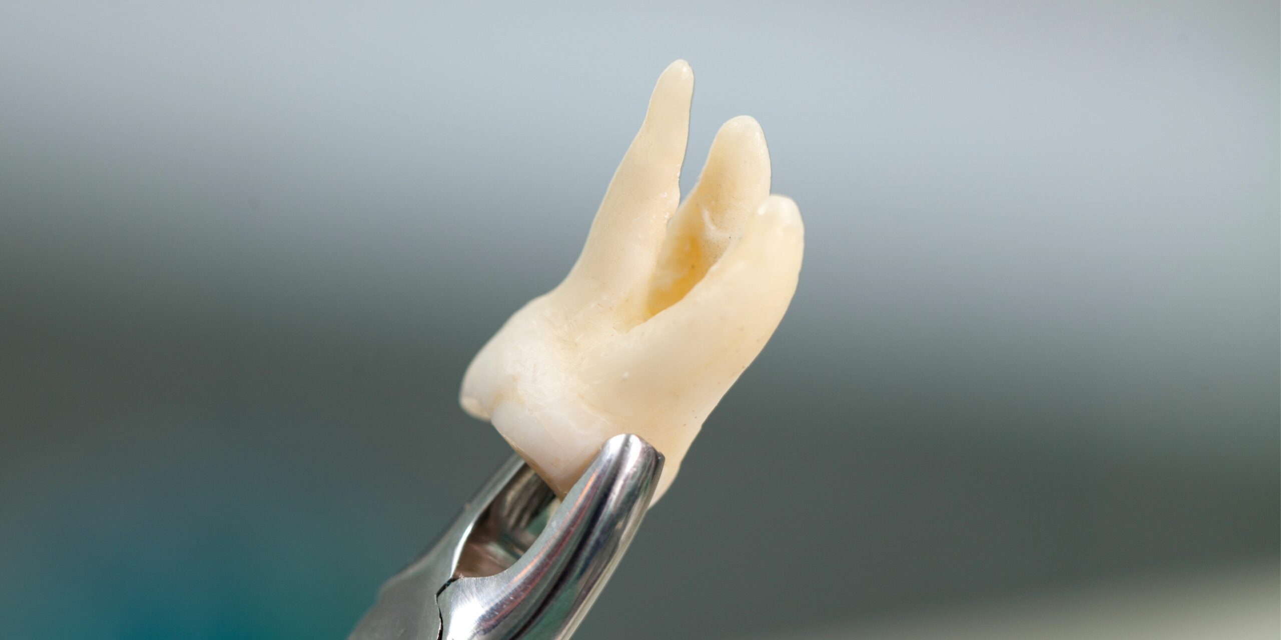 Todo lo que necesita saber sobre la extracción de cordales